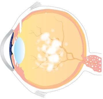 Eye Floaters Treatment | Vitreolysis laser treatment of floaters