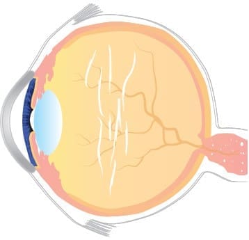 Eye Floaters Treatment | Vitreolysis laser treatment of floaters