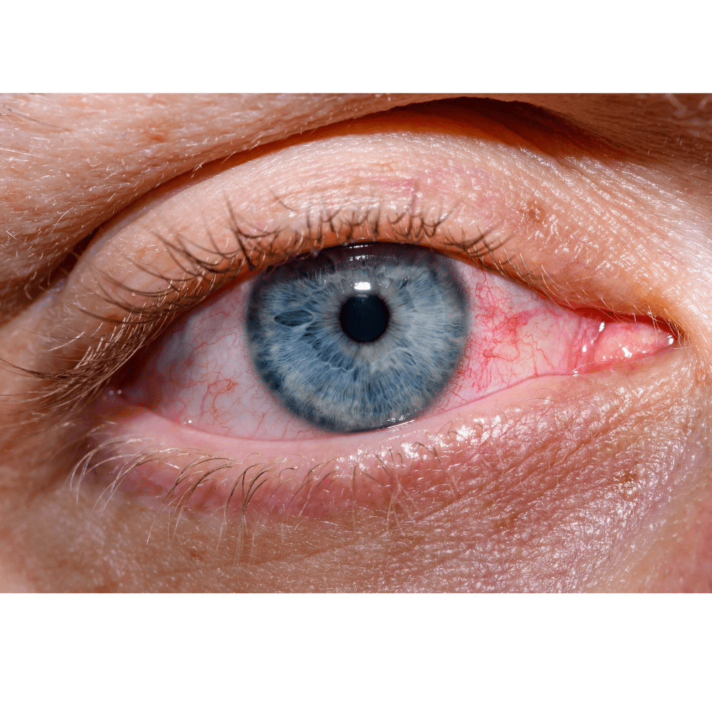 Understanding Red Eye Causes and Solutions